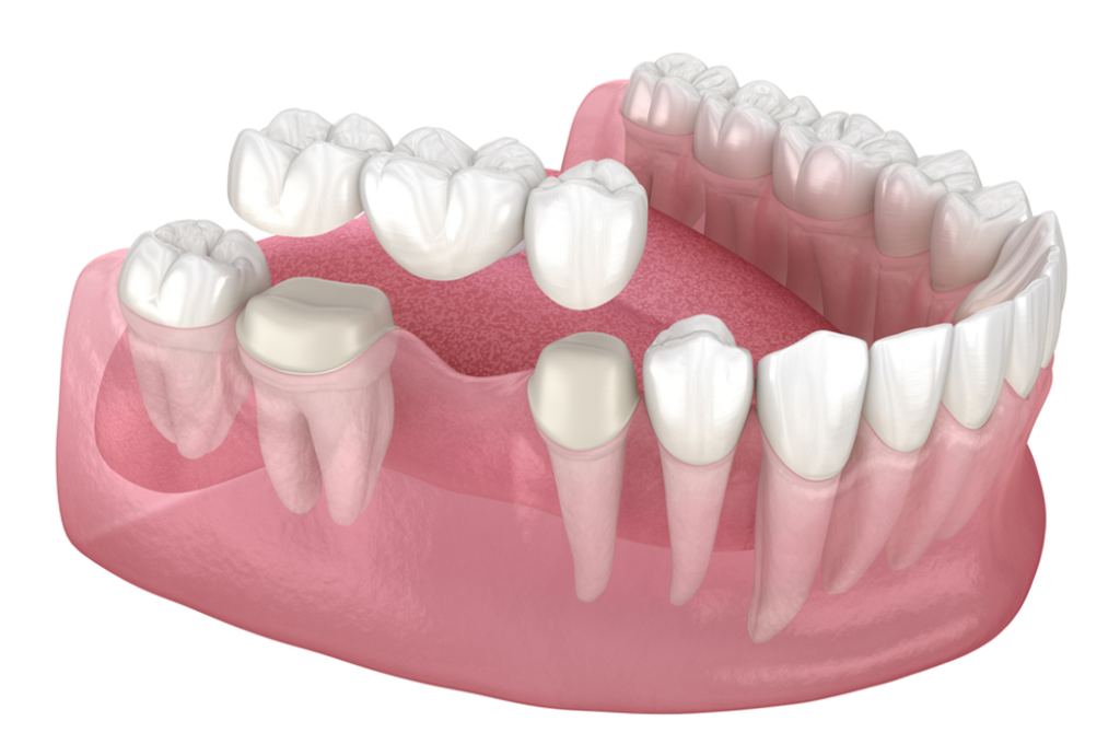 Dental Bridges: Types, Benefits, and Procedure - Bravo Dental Dallas