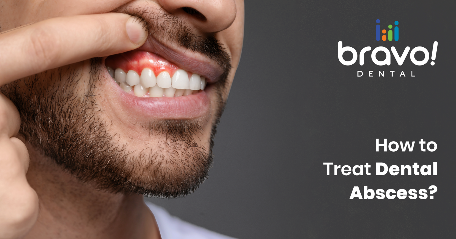 How to Treat Dental Abscess? - Bravo Dental Dallas